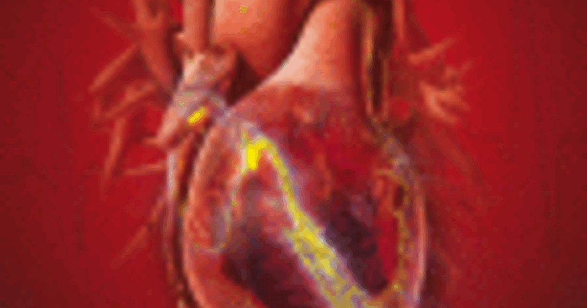 Defibrillator implantations for primary prevention in the United States ...